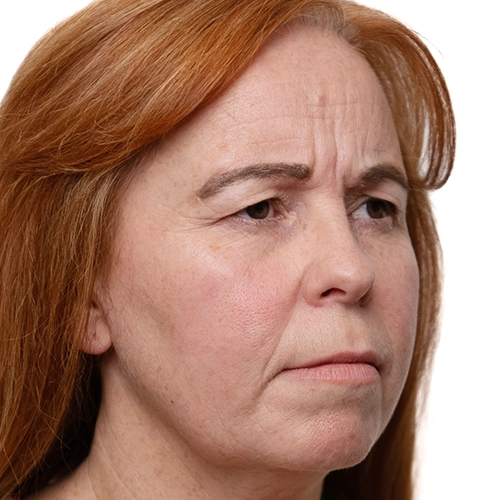 Botox Brow Lift: Achieve a Natural, Elevated Brow Arch - Thérapie ...